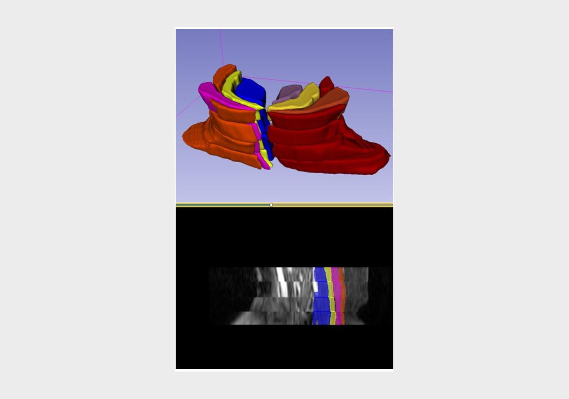 Novel MRI-Based Evaluation System Accurately Quantifies Paraspinal ...